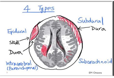 Ictus Cerebral 32 Quizlet