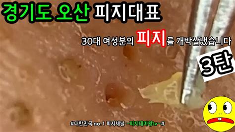 피지 직접 뽑아드렸습니다 피지제거 블랙헤드제거 피지뽑기 경기도를 통틀어 이분이 레전드가 될거 같은데 모두들 동의하시나요~ 30대 여성분의 피지를 산산조각 박살냈습니다
