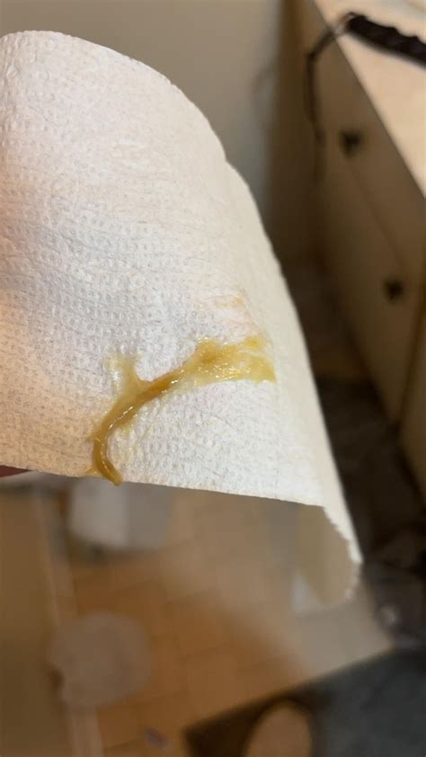 2 Months After Sinus Surgery Still Feeling Better But Terrible