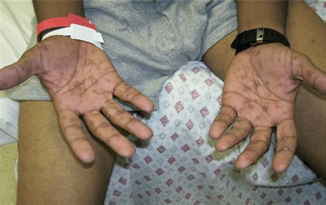 Palmar Rash Figure 2 Plantar Rash Used With Permission Of Nicholas Download Scientific