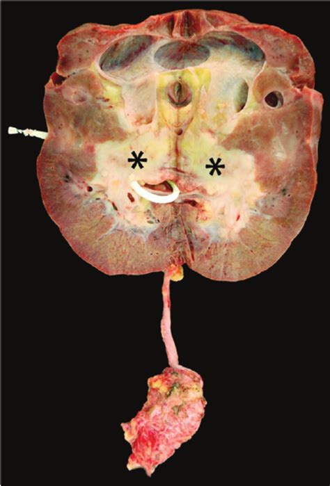 Allograft Nephrectomy Specimen Bivalved The Invasive Tumour