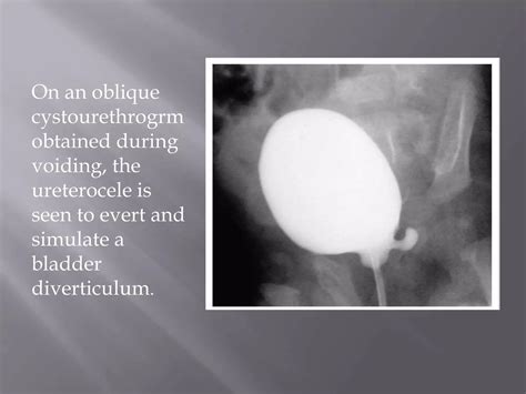 Mcu Micturating Cysto Urethrogram Pptx