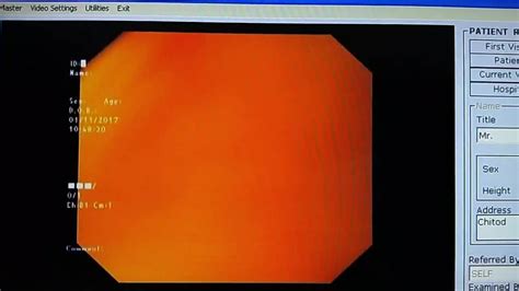 Dr Aaditya Rawat On Linkedin Acute Upper Gi Fundal Variceal Bleed Done Glue Therapy