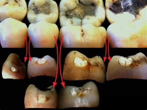 Class Ii Cavity Preparation For Amalgam Pptx