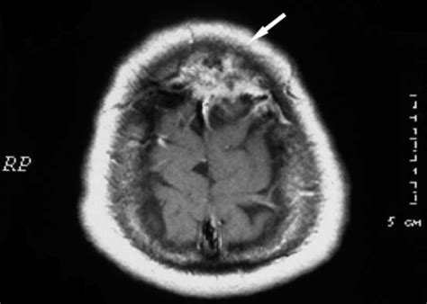 Cavernous Hemangioma Of The Skull Axial Mri In T1 Sequence Showing A