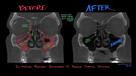 Understanding Sinusitis Jammed Plumbing Walnut Hill Ent Dallas Tx