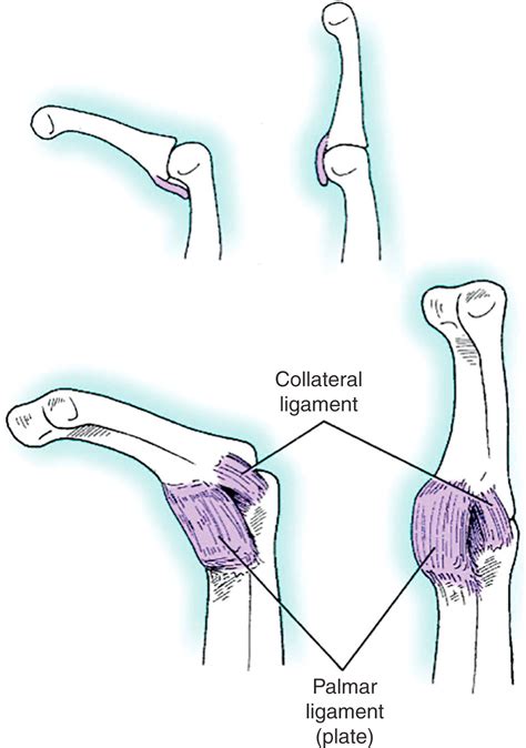 Metacarpophalangeal Joint Dislocations Clinical Tree