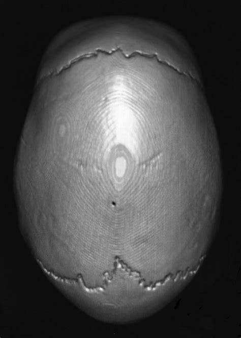 Sagittal Suture