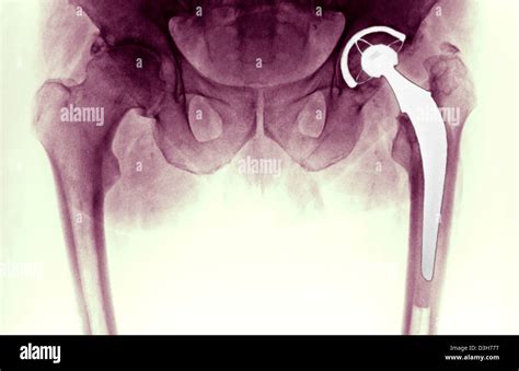 Hip Prosthesis X Ray Stock Photo Alamy