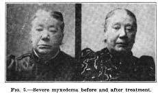 Hypothyroidism In Pictures Functional Performance Systems FPS