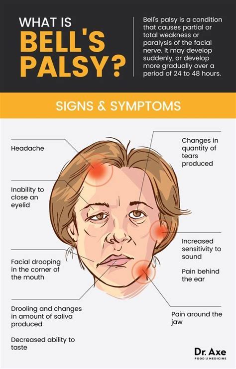 Bell S Palsy Symptoms And Causes Artofit