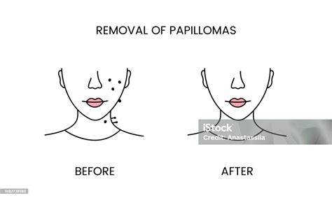 유두종 제거 시술 전 및 벡터에 치료 라인 아이콘을 적용한 후 레이저 미용 매끄럽고 깨끗한 피부와 문제성 피부를 가진 여성의 삽화 건강관리와 의술에 대한 스톡 벡터 아트 및