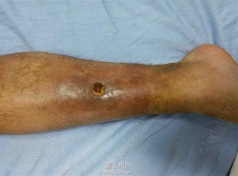 皮肤溃疡图 轻度 断 第8页 大山谷图库