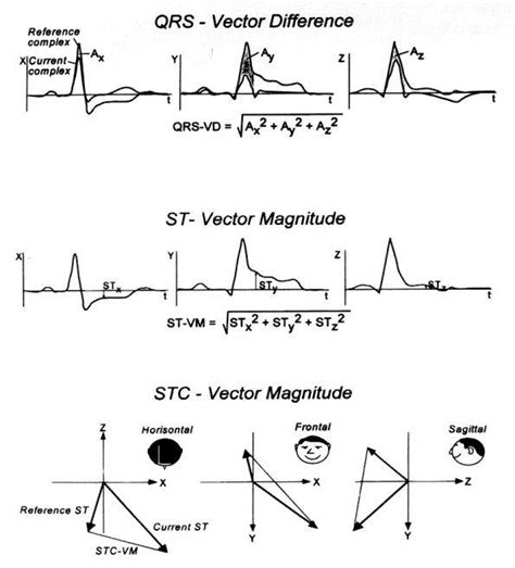vectorcardiographic variables qrs vd st vm and stc vm used in dvcg