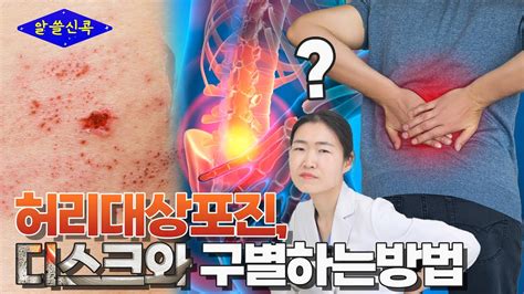 허리대상포진 디스크와 구별하는 방법 콕통증의학과 김선옥 원장 Youtube