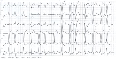 Narrow Qrs Lbbb Dr S Venkatesan Md