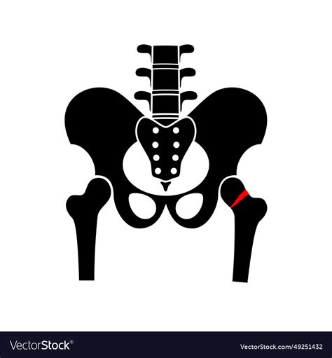 Hip Bone Fracture Royalty Free Vector Image Vectorstock