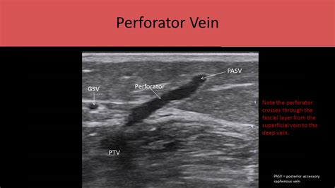 Popliteal Vein Branches Ultrasound