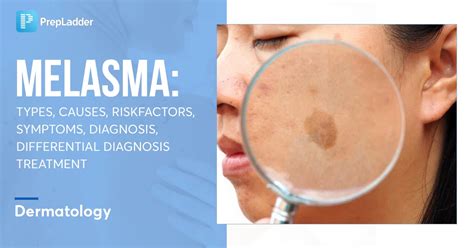 Melasma Types Causes Risk Factors Symptoms And Treatment