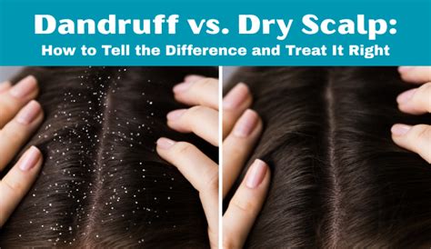 Dandruff Flakes Vs Dry Scalp Flakes
