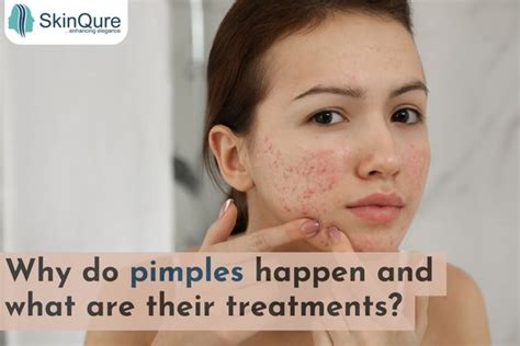 Why Do Pimples Happen And What Are Their Treatment SkinQure