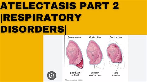 Atelectasis Part 2 Respiratory Disorders Medical Surgical Nursing Youtube Atelectasis Part 2 Respiratory Disorders Medical Surgical Nursing Youtube
