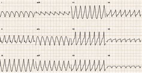 Brugada Algorithm Vt Vs Aberrant Svt Ecg Book