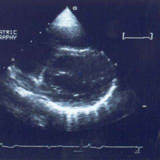 Two ECHO Pictures Showing Differing Tissue Density At The Region Of The Download Scientific