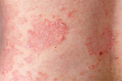 Papules Skin