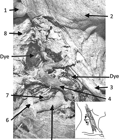 Cervical Plexus Block Radiology Key Cervical Plexus Block Radiology Key