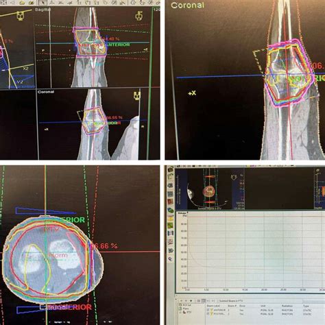 Diffuse Pigmented Villonodular Synovitis A Histological Examination