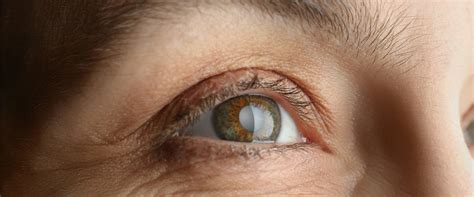 Can Cataracts Get Worse Without Surgery