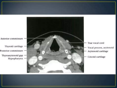 Larynx Anatomy Ct And Mri Ppt