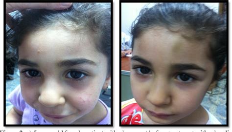 Figure 2 From Treatment Of Plane Wart With Topical Adapaline Gel 01