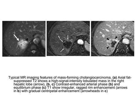 Diagnostic Imaging Of Cholangiocarcinoma PPT Digestive Disorders Diseases And Conditions