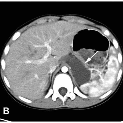 A Nonenhanced Multidetector Computed Tomography Mdct Scan Showing A