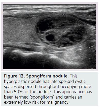 Thyroid Nodule Sonography Assessment For Risk Of Malignancy