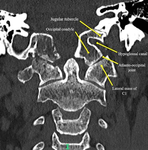 Occipital Condyle Anatomy Radiology