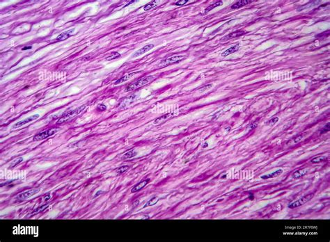 Uterine Fibroid Light Micrograph Lm Of A Section Through Tissue From
