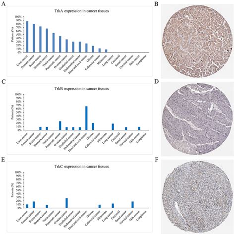 Trk Receptor Staining In Cancer A C And E Proportions Of Trk Download Scientific Diagram