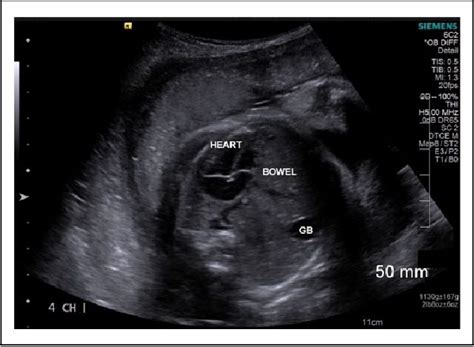 Diaphragmatic Hernia Ultrasound
