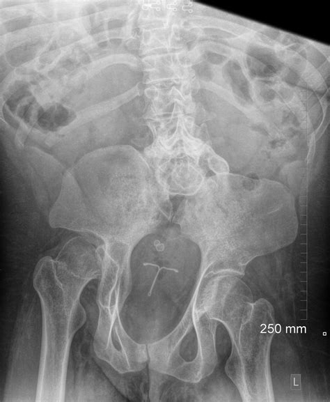 Sacral Agenesis Radiology Case Röntgen