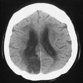 Cranial Computerised Tomography Showing Bilateral Hyperostosis Of The