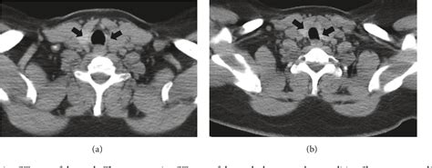 Figure 1 From Pneumomediastinum And Bilateral Pneumothoraces Causing
