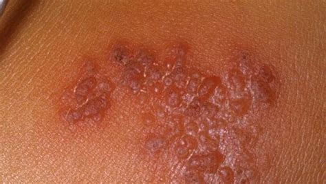 Трећих случај малих богиња у Београду Оболео осмогодишњи дечак — Rt Balkan