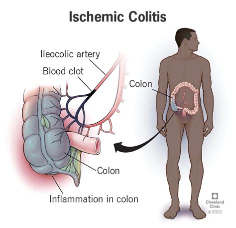 Ischemic Colitis Symptoms And Treatment