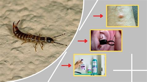 Earwig Bite Symptoms Dangers And How To Treat It