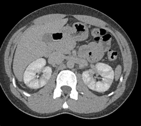Striated Nephrograms Due To Hypotension Genitourinary Radiology Case