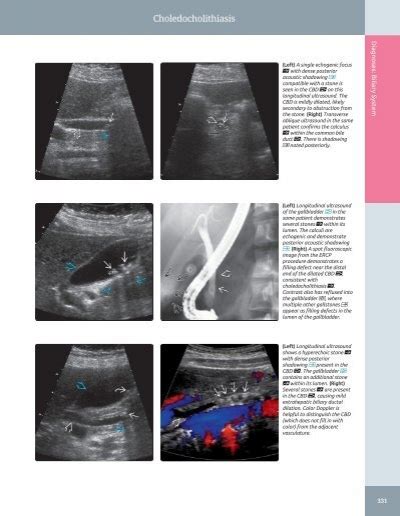 Choledocholithiasis Left