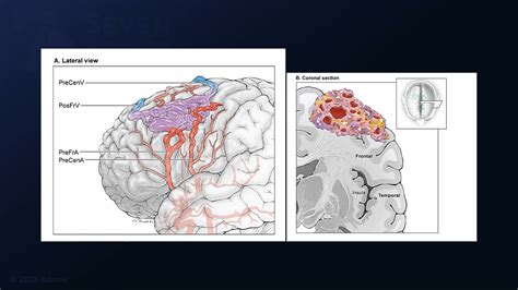Arteriovenous Malformation Seven Series Collection